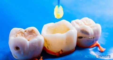 Common dental crown problems and solutions